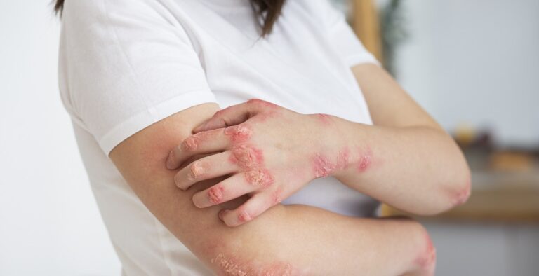 Lesi Kulit Apa Tanda-tandanya? Saatnya Waspadai Segera!