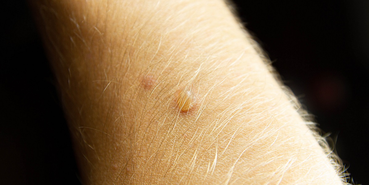 Cara Mengobati Bisul Kecil Dan Pencegahannya - Yoona