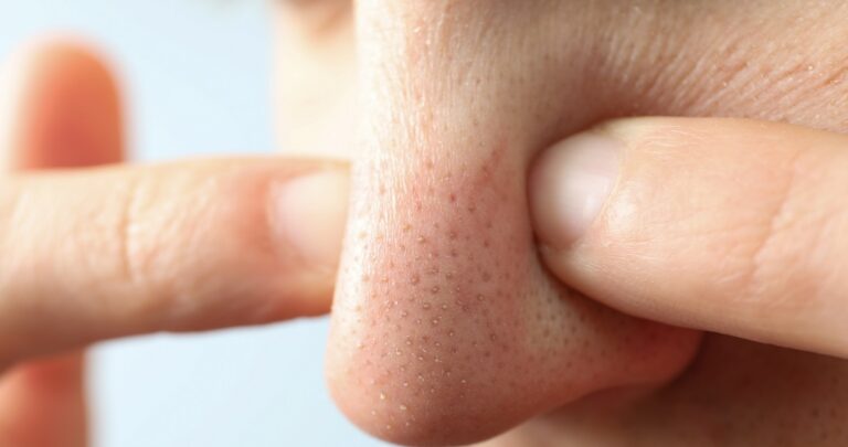 6 Cara Menghilangkan Komedo Putih di Hidung