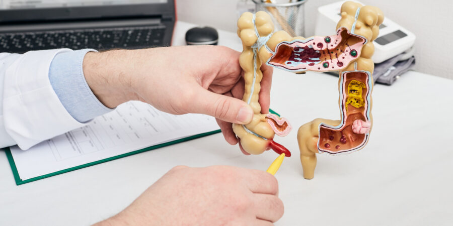 Usus Buntu: Penyebab, Ciri, Diagnosis, dan Pengobatan - Yoona