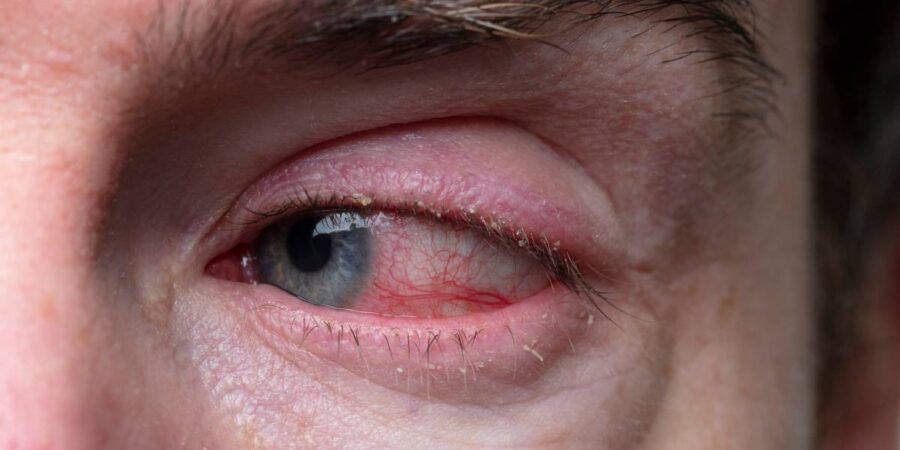 Blefaritis adalah Radang Kelopak Mata, Kenali Gejala hingga Cara ...