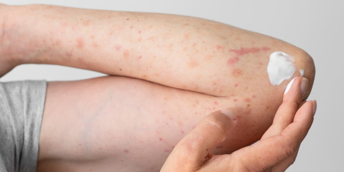 Tidak Sama, Ketahui Perbedaan Campak dan Alergi!