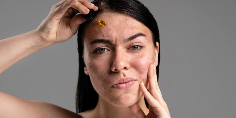 Skin Barrier Rusak? Ini 5 Cara Mengatasinya dengan Ampuh! - Yoona