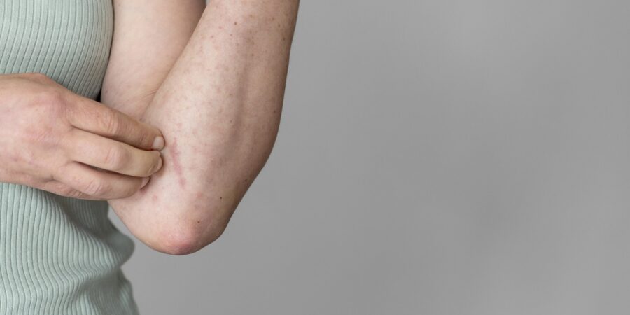 Kenali 7 Jenis Ruam Kulit Dan Tanda Bahayanya