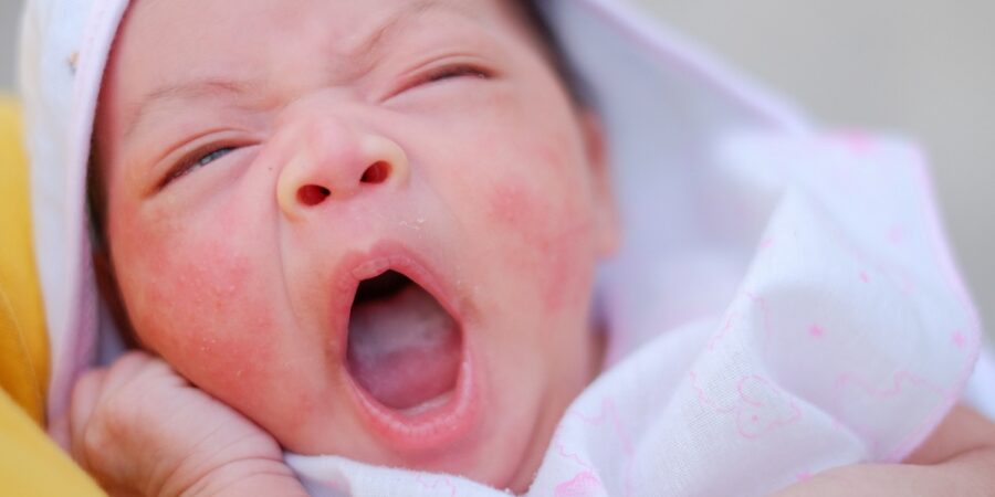 Penyebab Bibir Sumbing pada Bayi, Moms Wajib Tahu! - Yoona